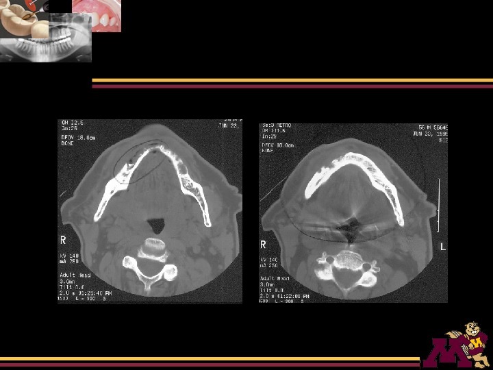 Radiographic Interpretation of Infections of Jaws Pericoronitis