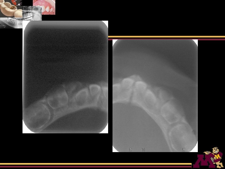 Radiographic Interpretation of Infections of Jaws Pericoronitis