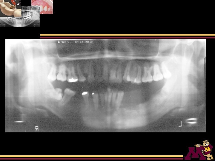 Radiographic Interpretation of Infections of Jaws Pericoronitis
