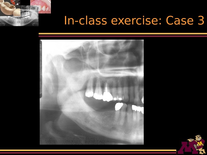 Radiographic Interpretation of Infections of Jaws Pericoronitis