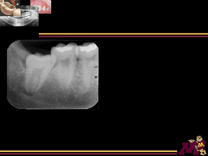 Radiographic Interpretation of Infections of Jaws Pericoronitis