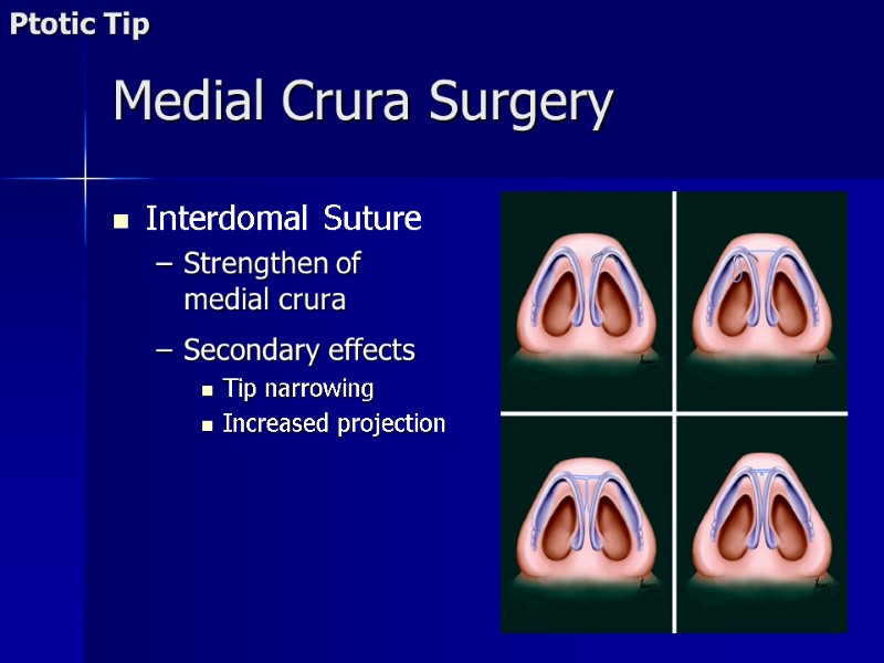 Rhinoplasty- Nasal Tip Jean Paul Font, MD Raghu