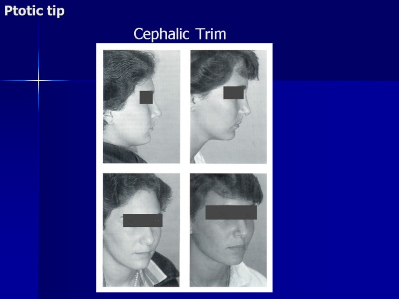 Rhinoplasty- Nasal Tip Jean Paul Font, MD Raghu