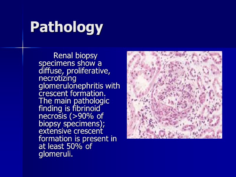 RENAL DISEASE Acute glomerulonephritis Acute GN is characterized