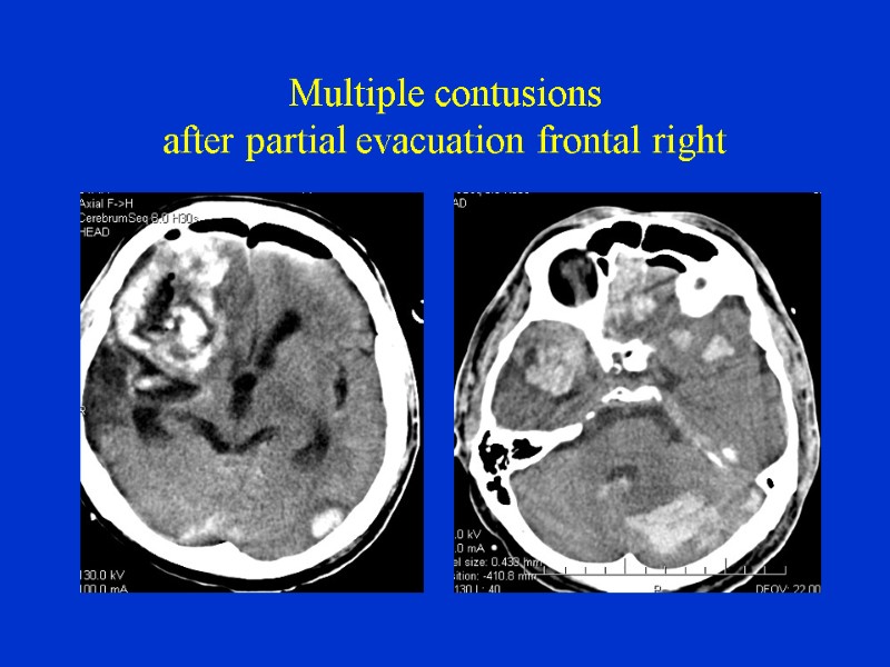 Craniocerebral Injury Jaroslav Plas Dept. of Neurosurgery, 1st