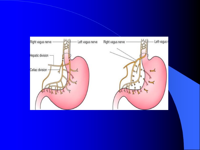 Gastric and duodenal ulcer disease Anatomy Arterial blood
