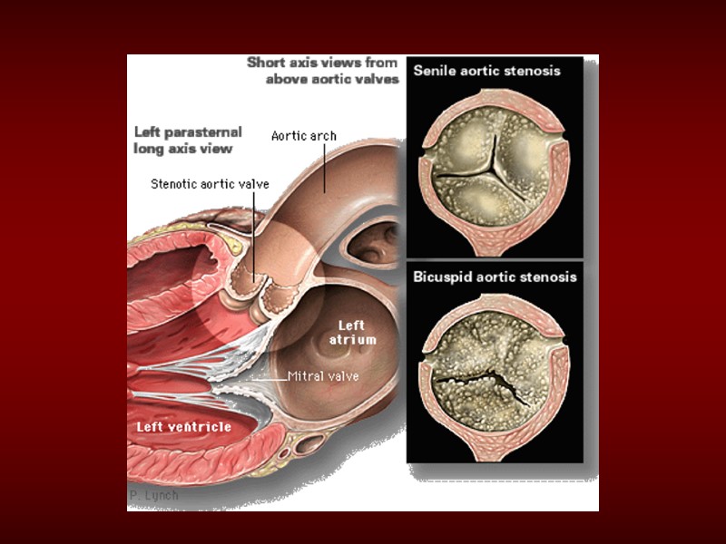 VALVULAR HEART DISEASE Internal Medicine Didactics August 12,