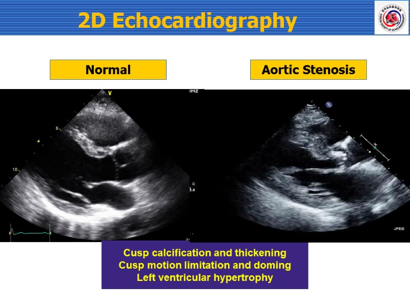 Aortic Valve Disease Normal Aortic Valve Parasternal long