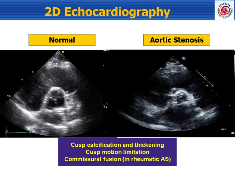 Aortic Valve Disease Normal Aortic Valve Parasternal long