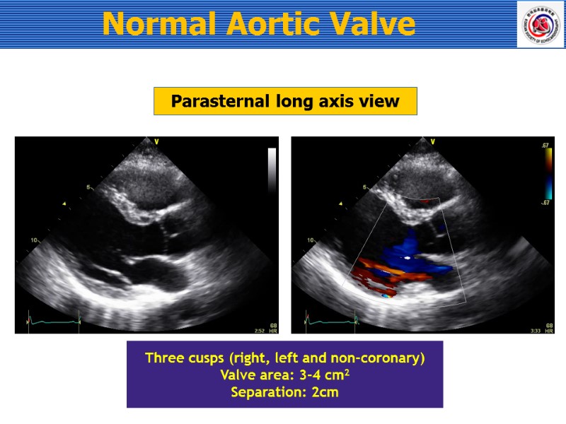 Aortic Valve Disease Normal Aortic Valve Parasternal long