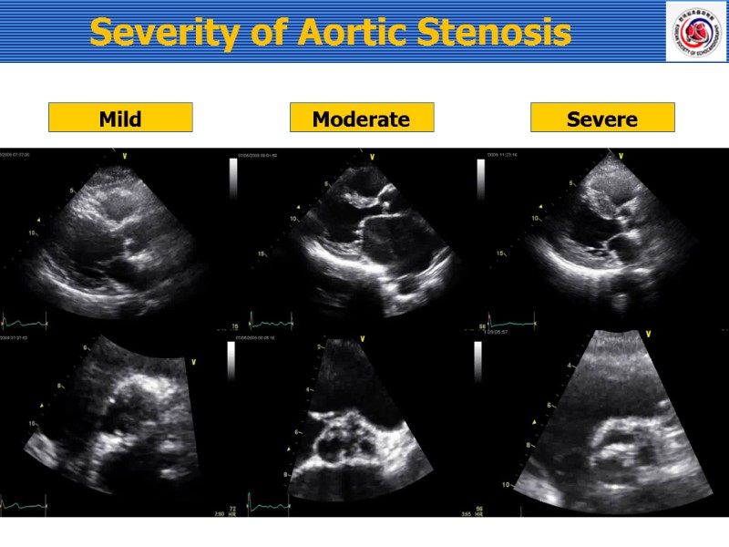 Aortic Valve Disease Normal Aortic Valve Parasternal long