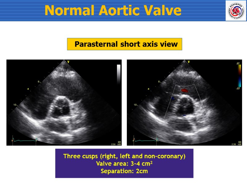 Aortic Valve Disease Normal Aortic Valve Parasternal long