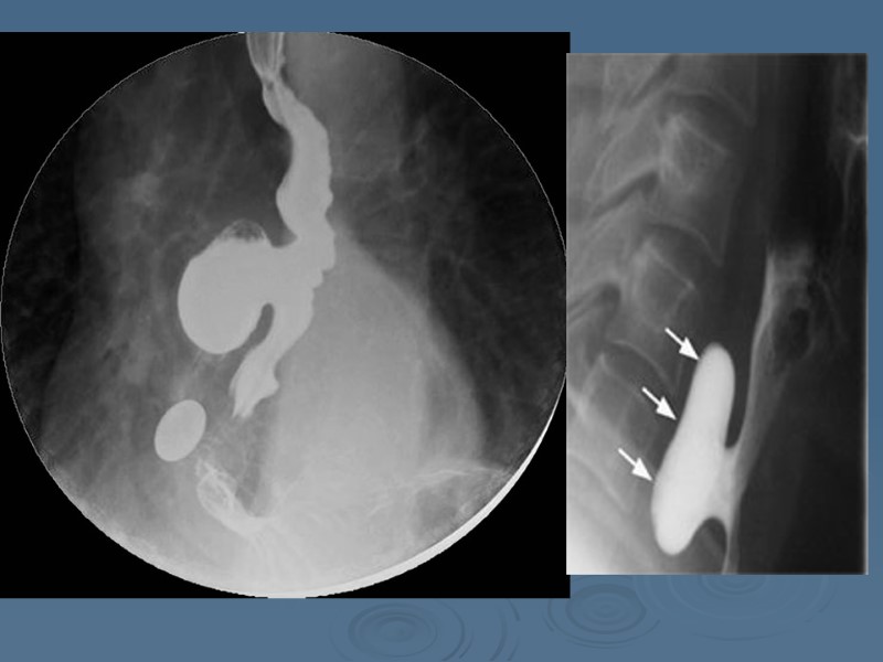 Еsophageal disease (stricture, diverticula, achalasia) Surgery ...