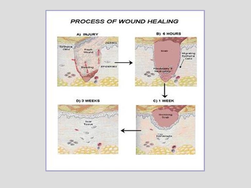 http://emedicine.medscape.com/article/1298129-overview#aw2aab6b4 Wound ...