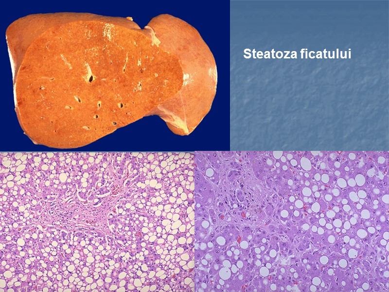 Patologia stomacului. intestinului şi ficatului GASTRITA ACUTĂ ULCER