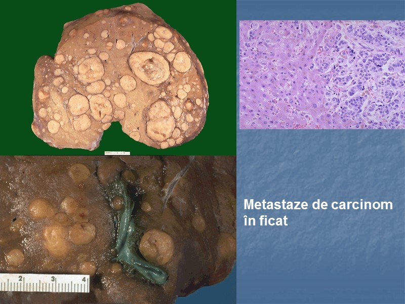 Patologia stomacului. intestinului şi ficatului GASTRITA ACUTĂ ULCER