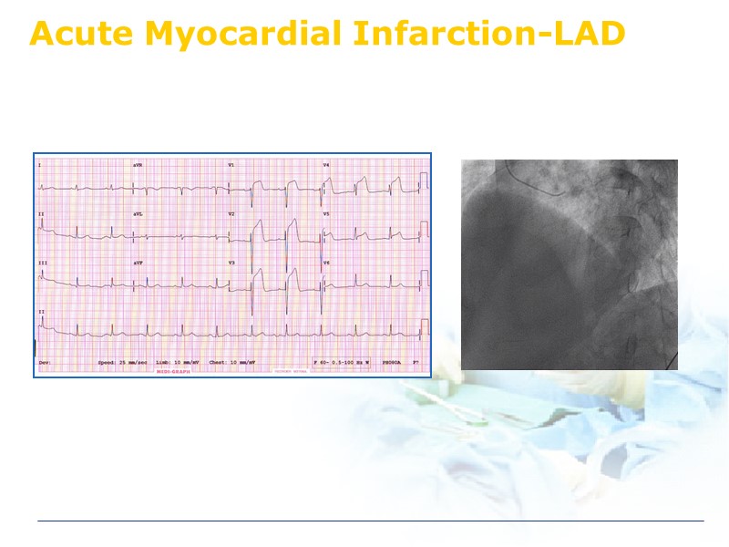 Ischmic Heart Disease Myocardial Infarction Current clinical practice