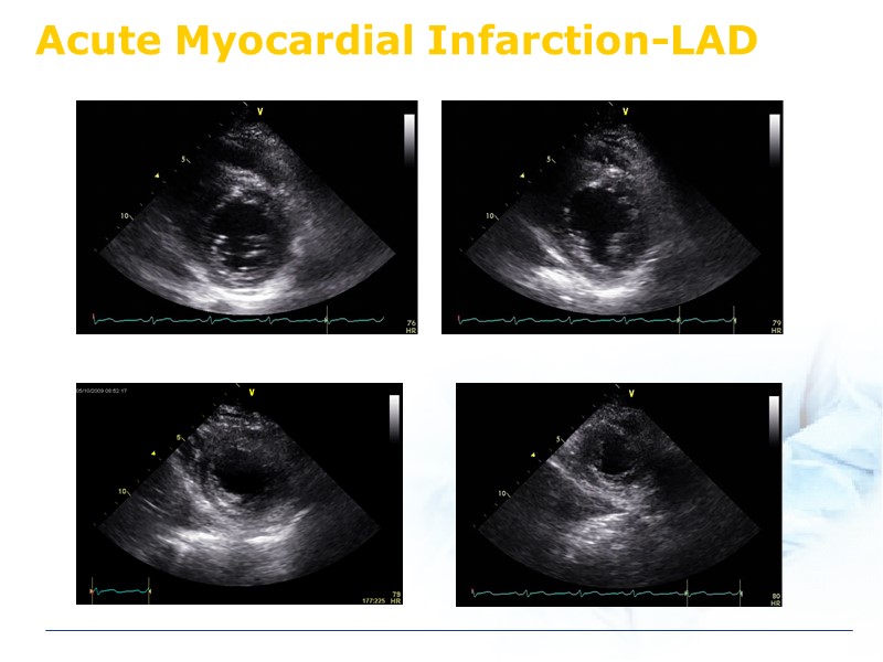 Ischmic Heart Disease Myocardial Infarction Current clinical practice