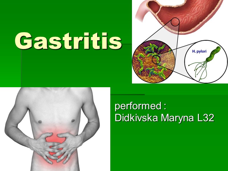 Gastritis performed : Didkivska Marуna L32 Gastritis-is an