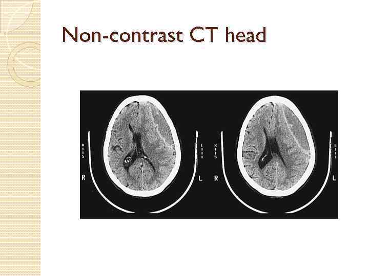 Headaches Gerald F Smith MPH MS PA-C Neurology