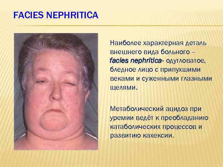 СЕМИОТИКА ЗАБОЛЕВАНИЙ ПОЧЕК Медведева Т А Кафедра внутренних