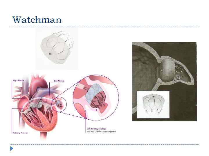 Новые технологии в лечении фибрилляции предсердий Саввинова Полина
