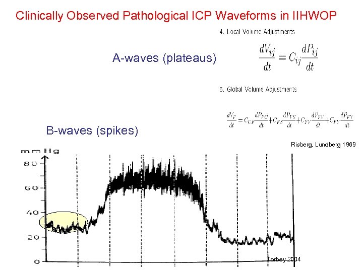 Modeling Idiopathic Intracranial Hypertension with a semicollapsible sinus