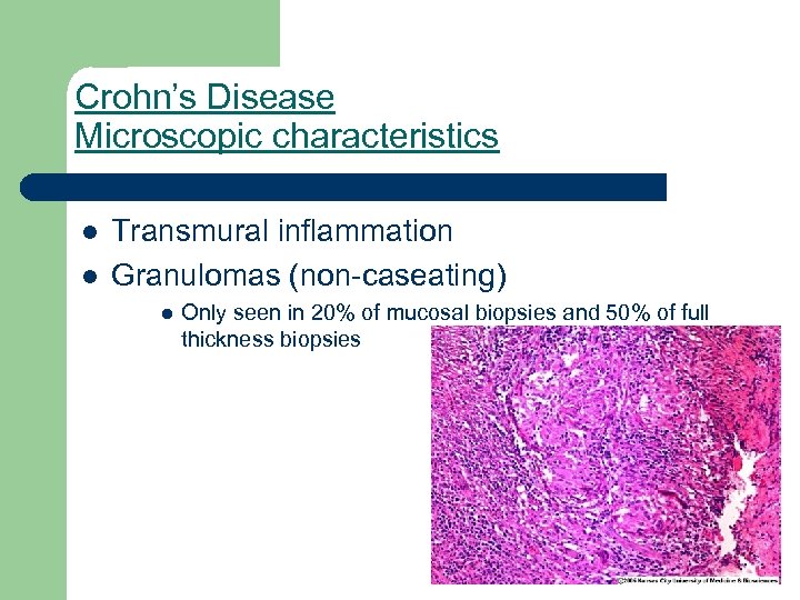 Inflammatory Bowel Disease Dr WM Simmonds Internal Medicine
