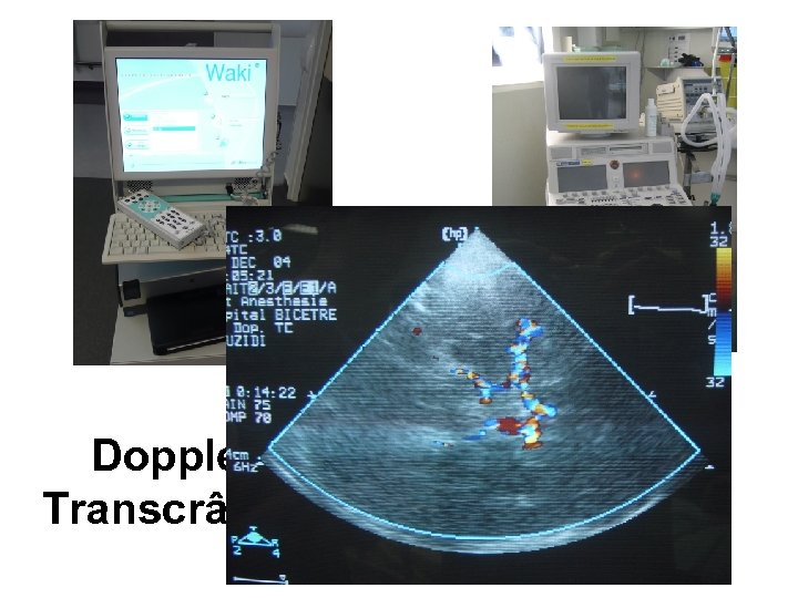Le Doppler transcrânien principes intérêt à l accueil des