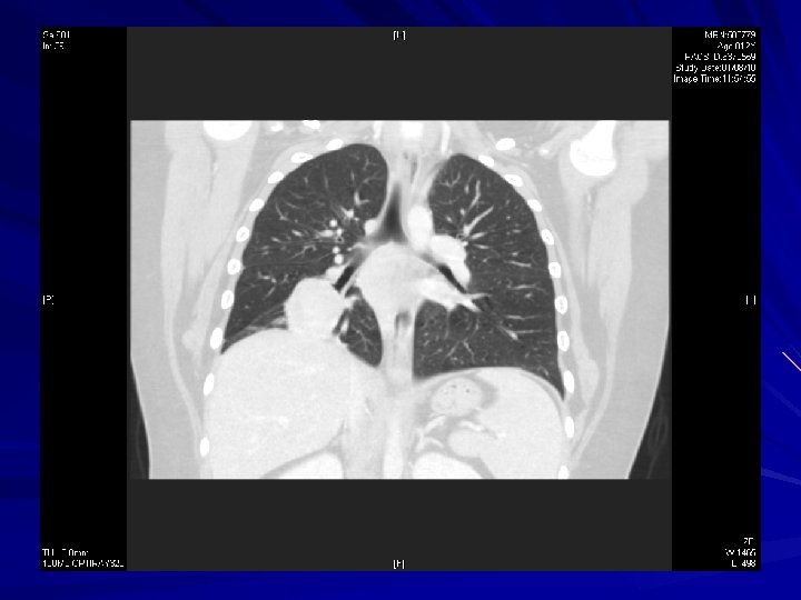 Bronchial Carcinoid Tumors Heather Wheeler MD February 4