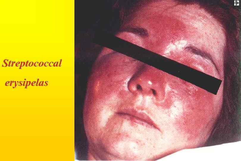 Воспаления СТОМАТИТ КРАЕВОЙ ГИНГИВИТ Streptococcal erysipelas