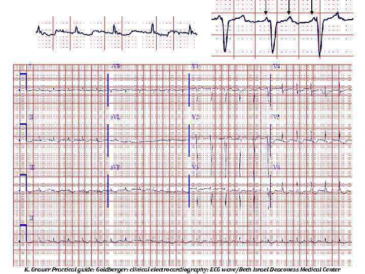 Интерпретация ЭКГ Нарушения ритма Дубикайтис Т А к