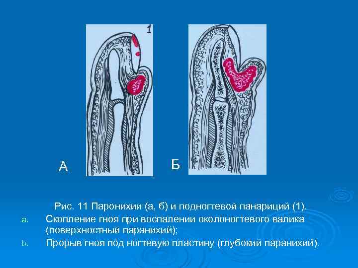 ЛЕКЦИЯ № 5 Гнойные заболевания