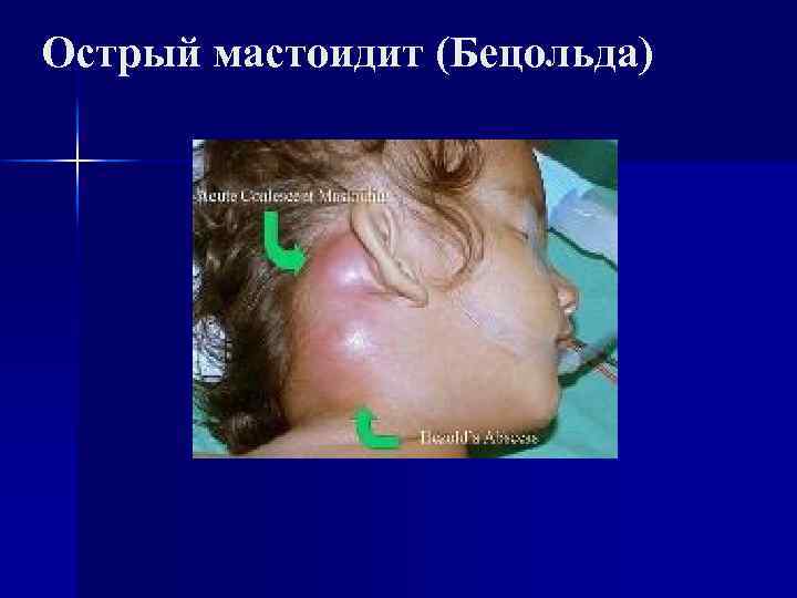 Острые заболевания уха наружный отит острый средний отит