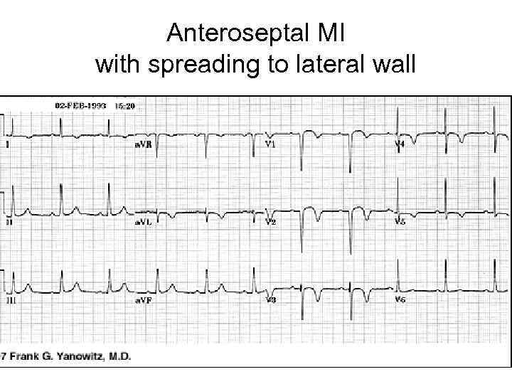 Myocardial infarctions Initial period High-amplitude positive