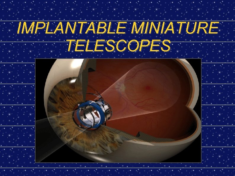 IMPLANTABLE MINIATURE TELESCOPES An introduction by James
