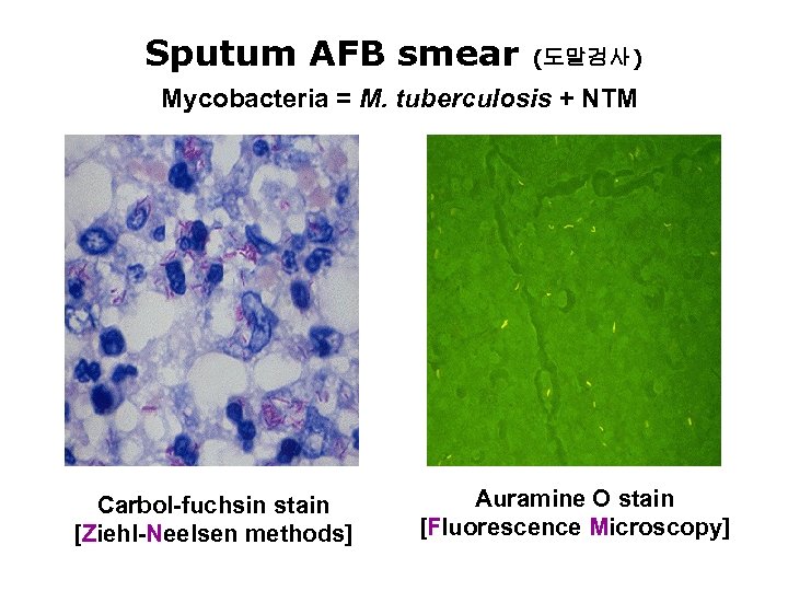 Diagnostic methods of pulmonary tuberculosis Yee Hyung Kim
