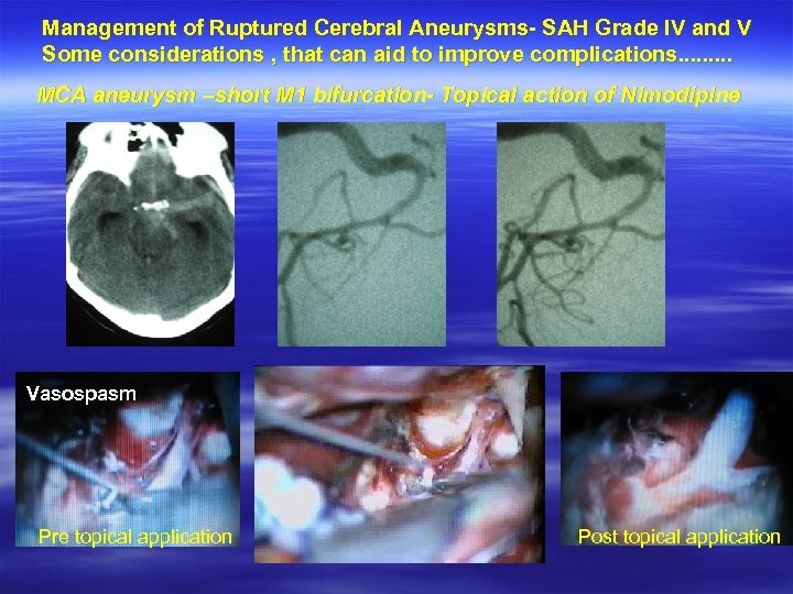 Management of Ruptured Cerebral Aneurysms with Poor Grade