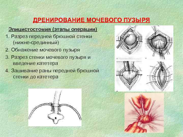 тема ХИРУРГИЧЕСКАЯ АНАТОМИЯ ТАЗА ОПЕРАЦИИ ПРИ РАНЕНИЯХ ОРГАНОВ