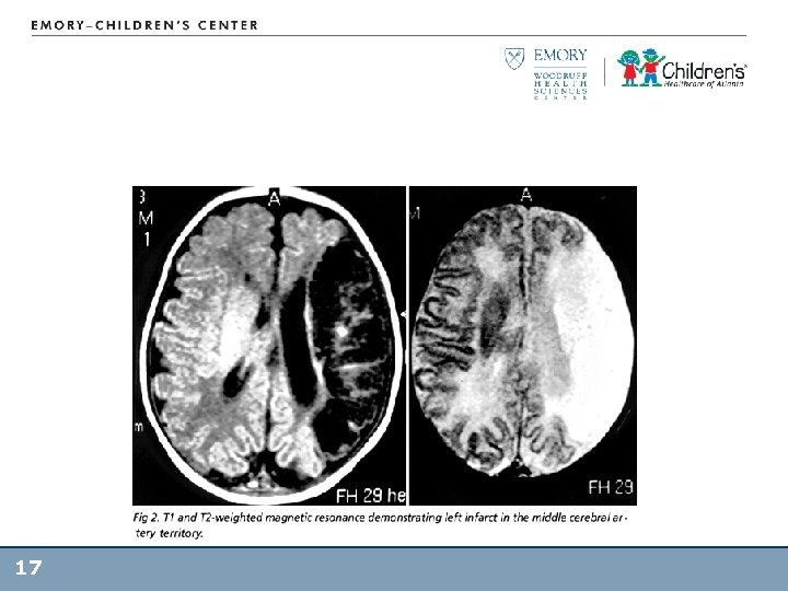 CEREBRAL VASCULAR ACCIDENTS Pediatric Critical Care Medicine Emory