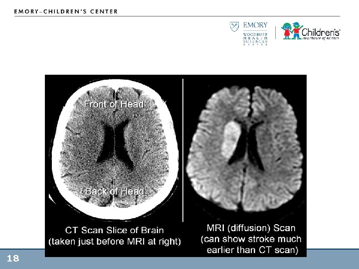 CEREBRAL VASCULAR ACCIDENTS Pediatric Critical Care Medicine Emory