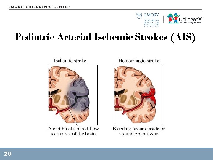 CEREBRAL VASCULAR ACCIDENTS Pediatric Critical Care Medicine Emory