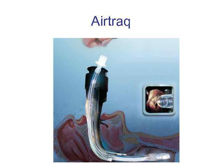 Трудные дыхательные пути Леонид Кривский БУС 22 -24 4 2015