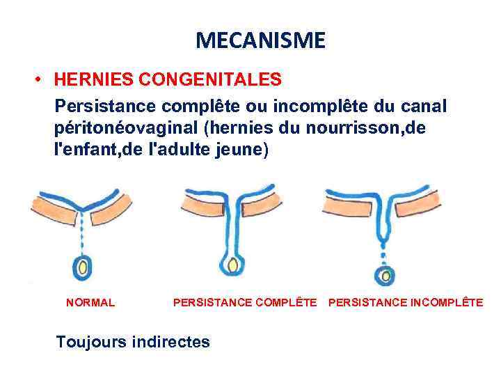 L 2 2014 HERNIES ET EVENTRATIONS HERNIES