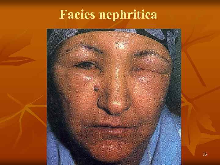 Основные синдромы при заболеваниях почек n n Мочевой