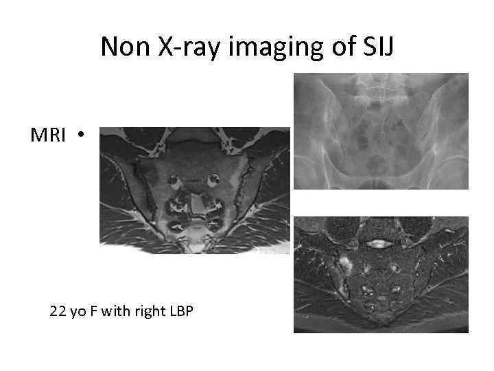 Ankylosing Spondylitis Gleb Slobodin MD 2017 Discovery