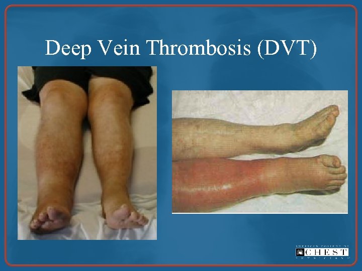 Prevention of Venous Thromboembolism in Nonorthopedic Surgical Patients