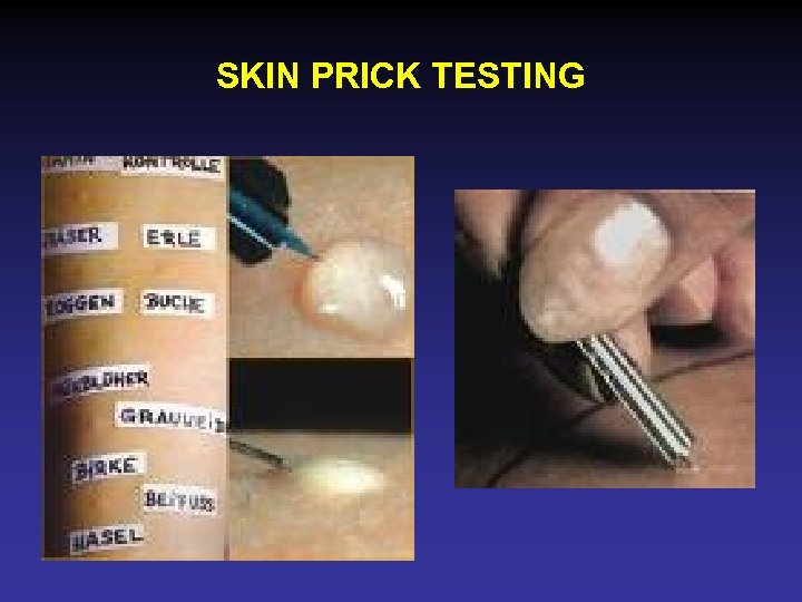 Basics in paediatric allergology Ig E-mediated allergy in