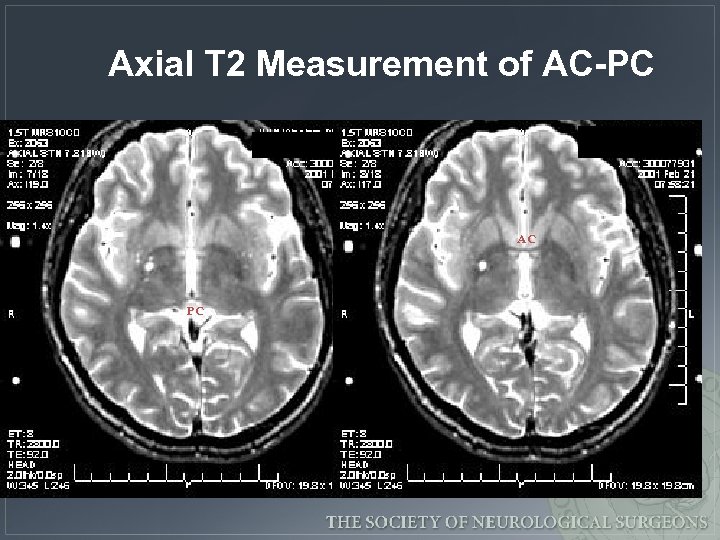 Principles of Neuronavigation Frame and Frameless