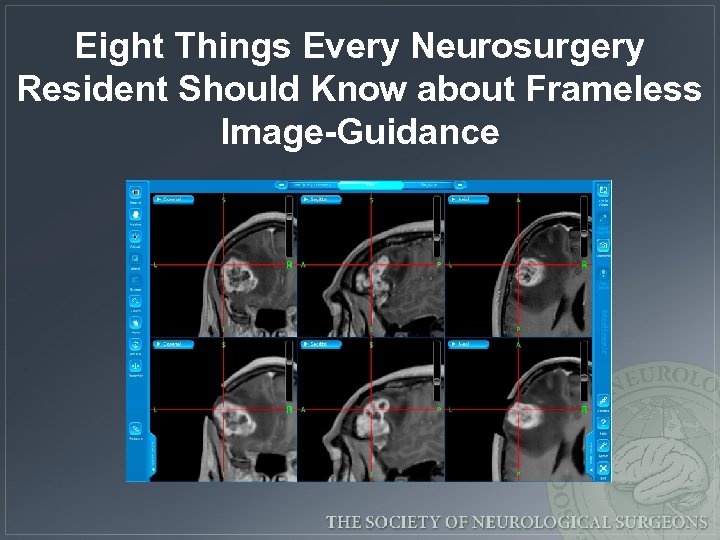 Principles of Neuronavigation Frame and Frameless